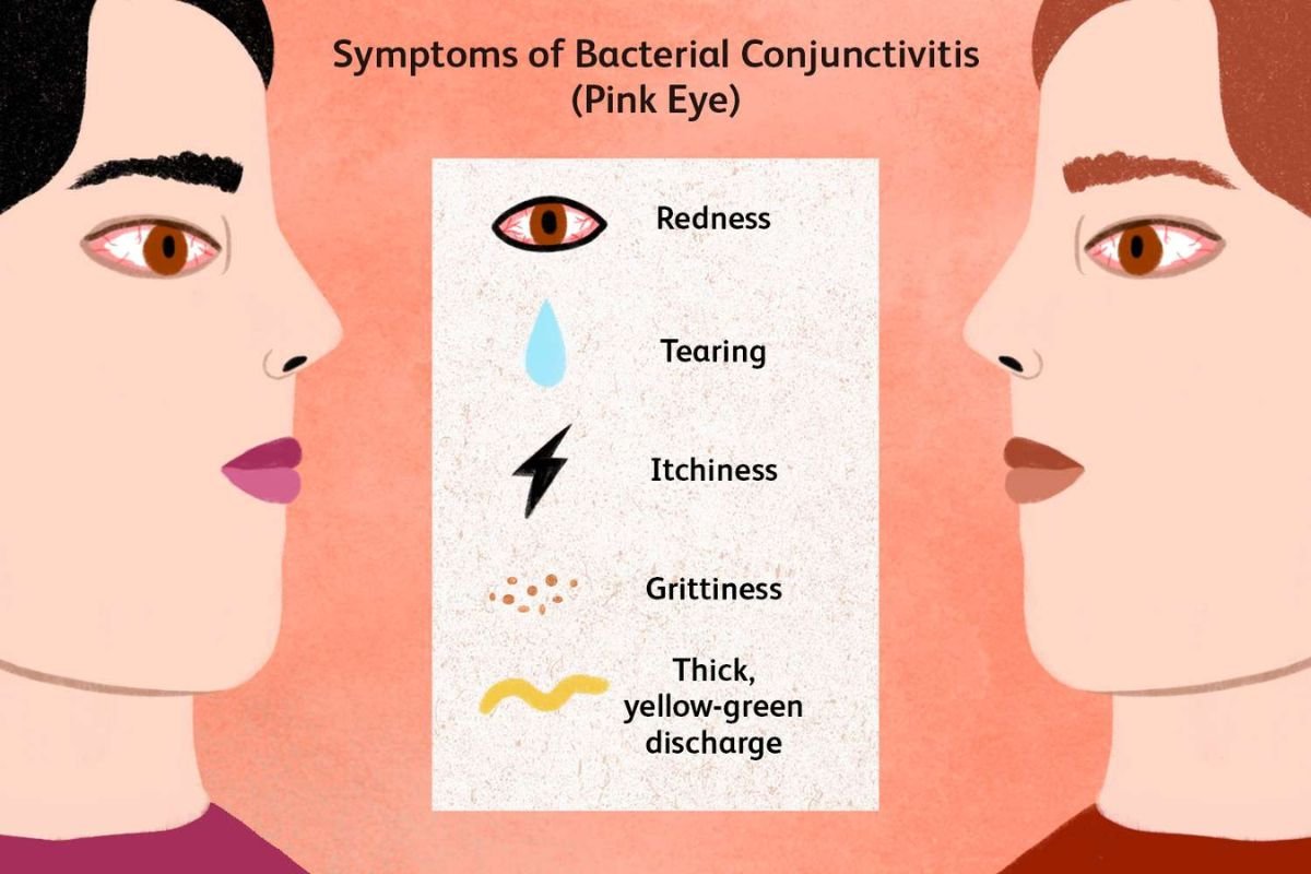 Conjunctivitis Symptoms, Pink Eye Diagnosis, Treatment, Medicine and ...